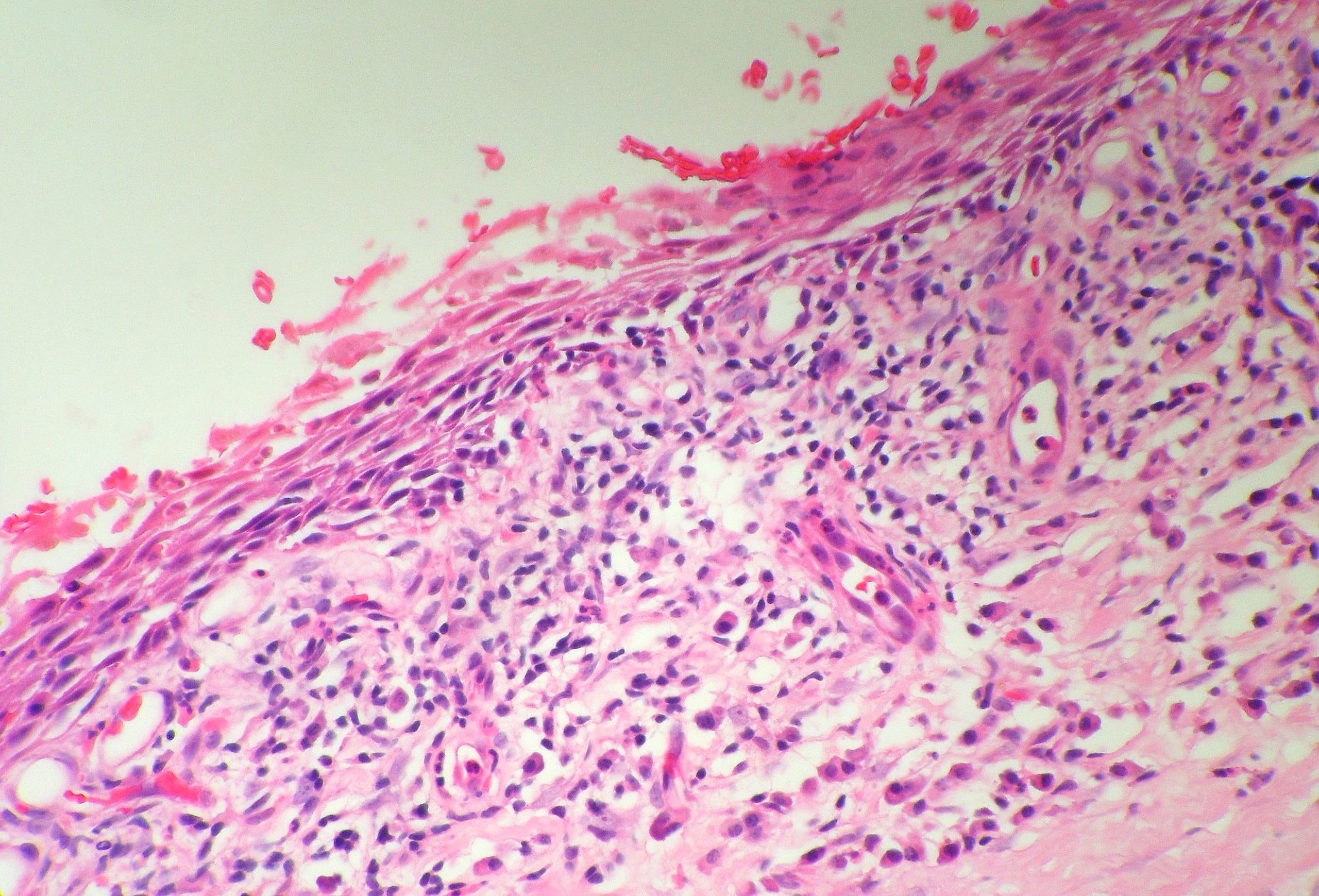 Balanitis – Consent Culture
